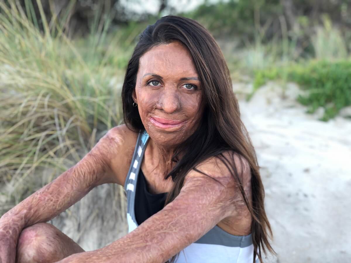 Sevgilisinin Desteğiyle Hayata Yeniden Tutunan Mucize Kadın: Turia Pitt