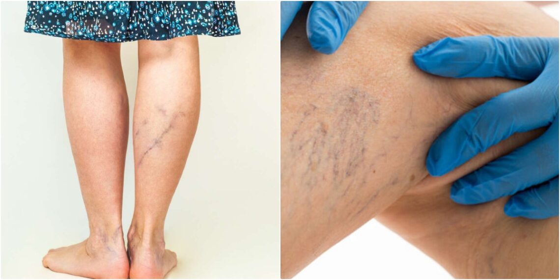 Varis Tedavisi Nasıl Olur? Bacak Varisleri Nedir? Çeşitleri Nelerdir?