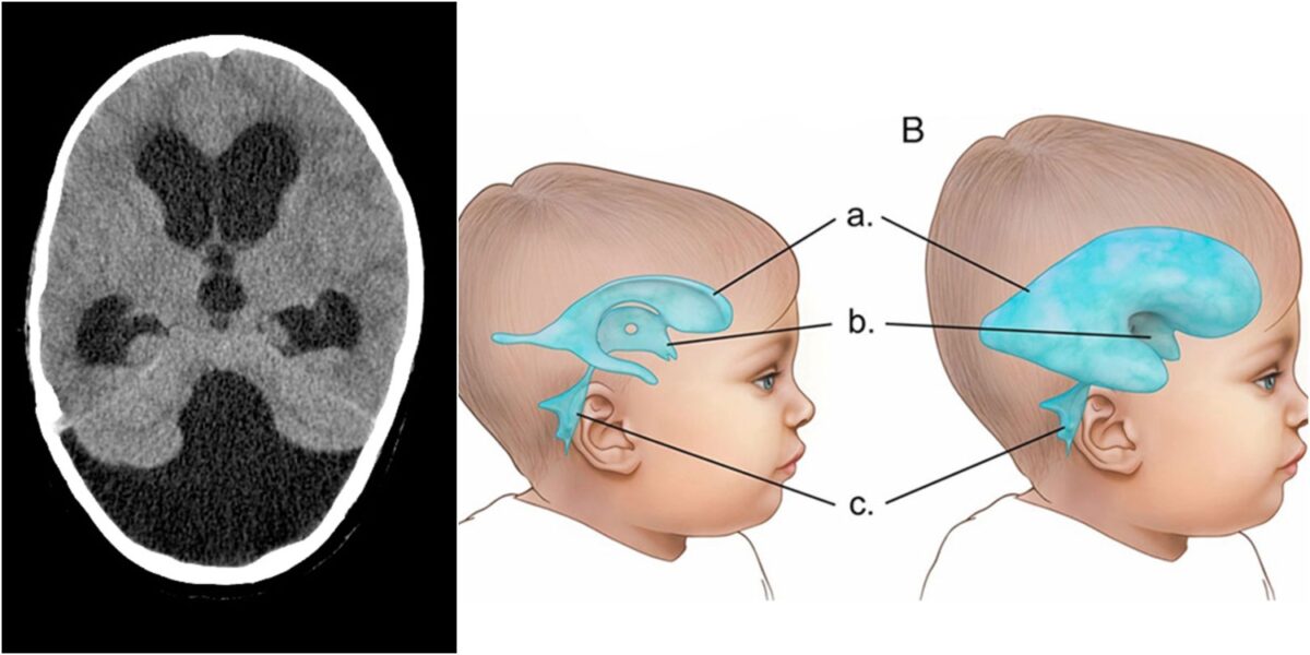Nadir Görülen Bir Anomali: Dandy Walker Sendromu Nedir?